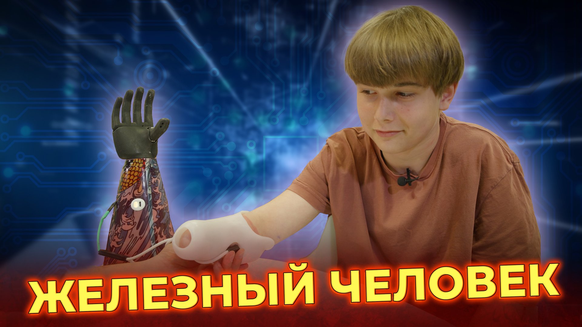 Железный человек. Петарда оторвала руку по локоть