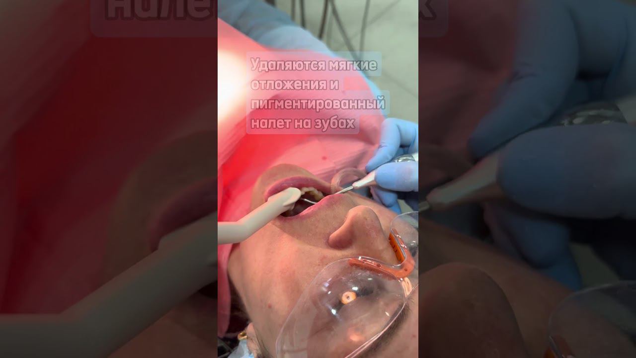 Профессиональная чистка зубов #читсказубов #зубы #стоматология