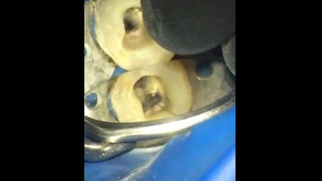 2020_05_20_Распломбировка пасты и байпас обломка.