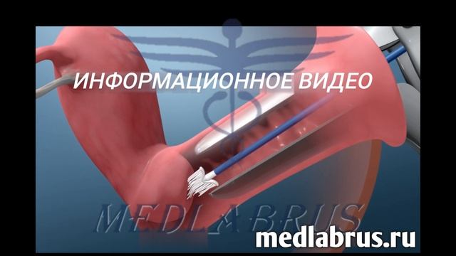 ПАП-тест: этапы процедуры и важность анализа