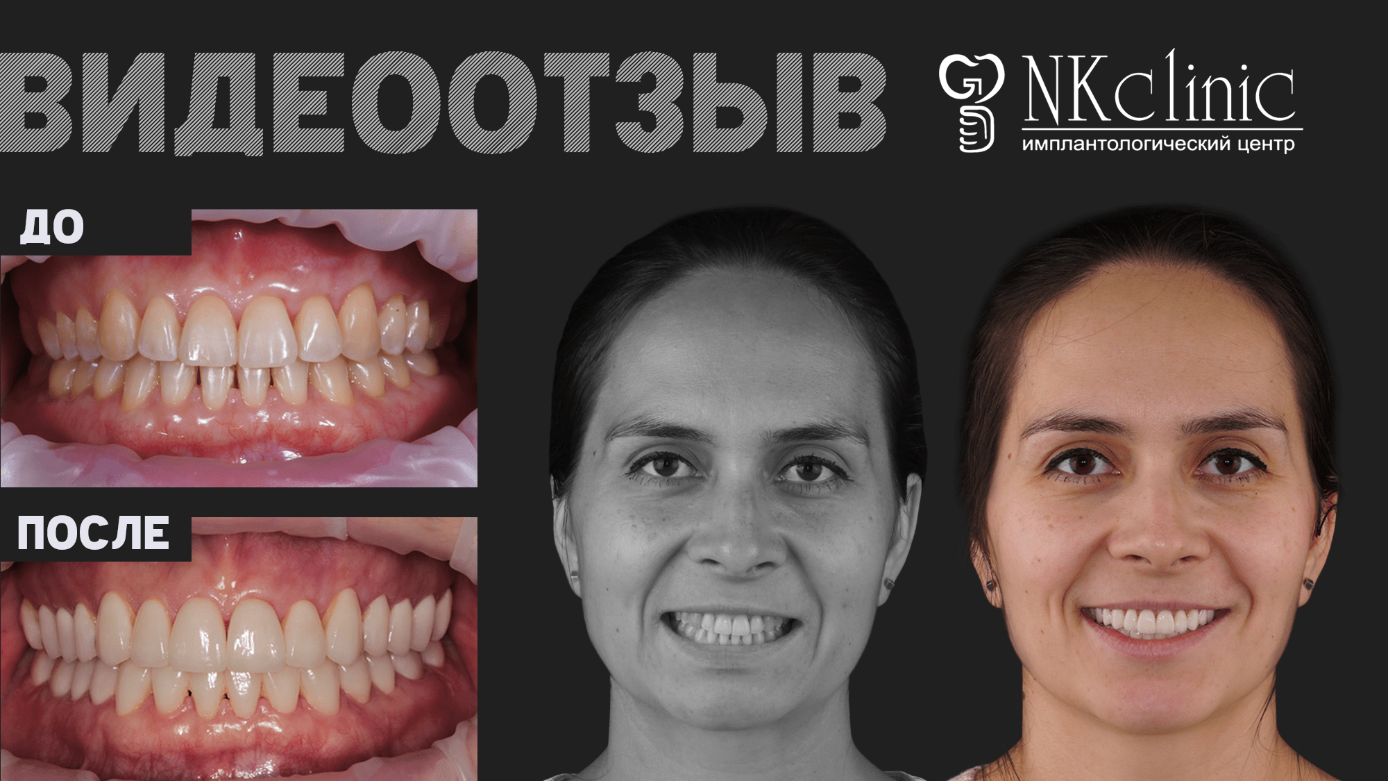Неправильный прикус и головные боли. Видеоотзыв пациентки NKclinc