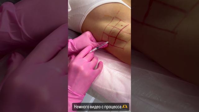 Мезотерапия подмышечных впадин (процесс)