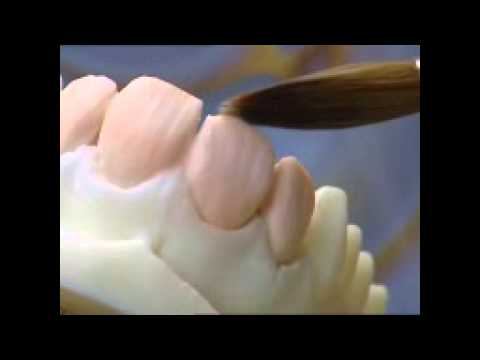 Облицовка керамических колпачков из HeraCeram Press керамикой HeraCeram