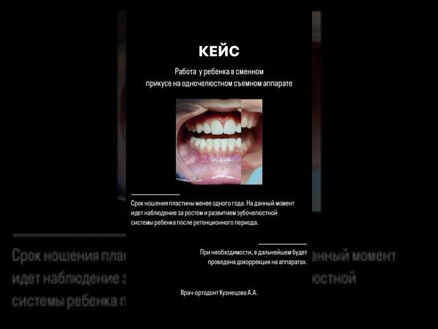 Исправление зубов у ребенка #зубы #стоматолог #ортодонт #брекеты #ортодонтия #shorts #shortvideo