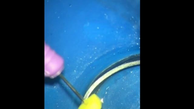 2020_05_19_Огромный не состоятельный мостовидный протез + ограничено время.