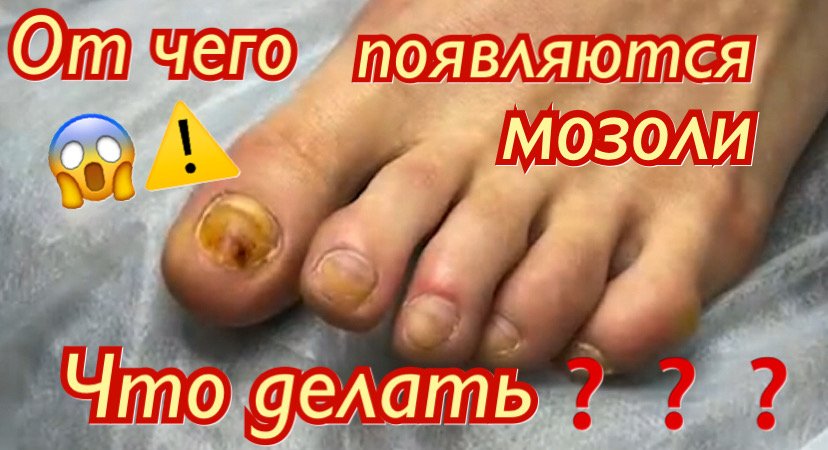 От чего появляются мозоли⚠️❗️??❓❓❓