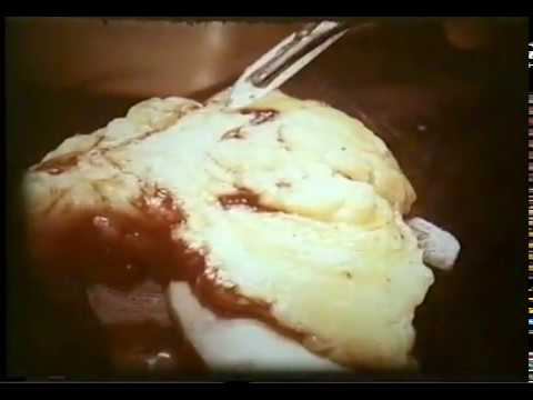 Липома, опухоль молочной железы - срочная биопсия © lipoma, rush biopsy, Academician V.Paukov