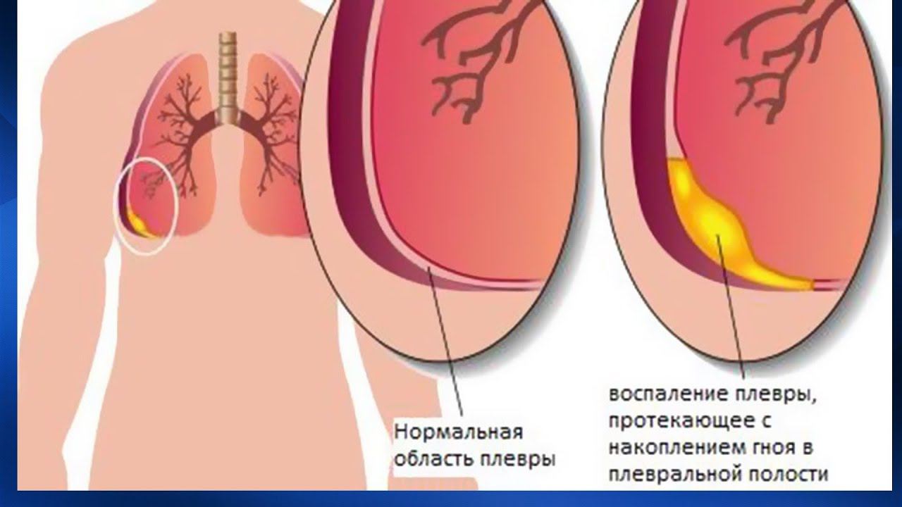 2.15. Массаж при плеврите | Медицинский массаж. Цикл 2