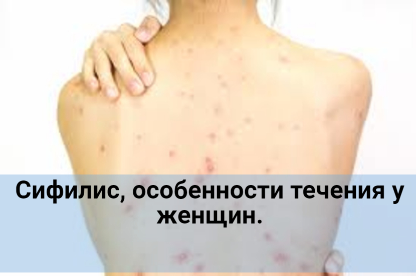 Сифилис, особенности течения у женщин. Высыпания на коже единственный симптом.