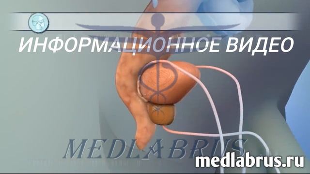 Рак предстательной железы-способы его лечения.