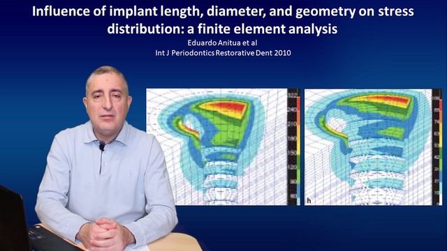 Какой длины должен быть имплант (Длина импланта)