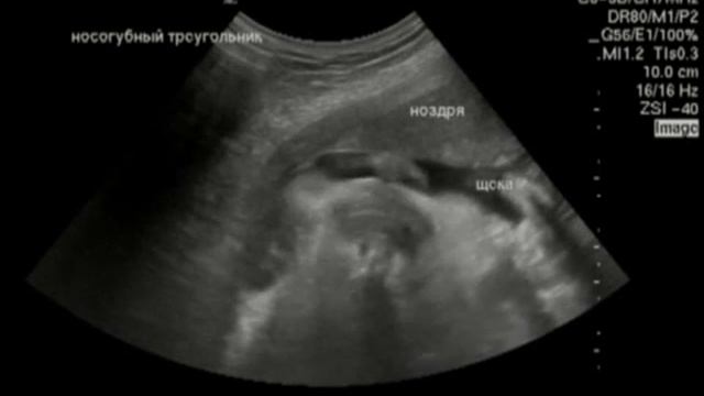 МАЛЫШ очень мило и смешно ЖУЕТ В ЖИВОТЕ у матери. Беременность 36 недель