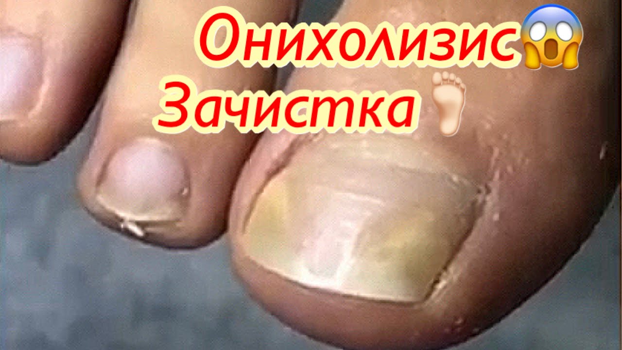 Онихолизис ? • Зачистка??
