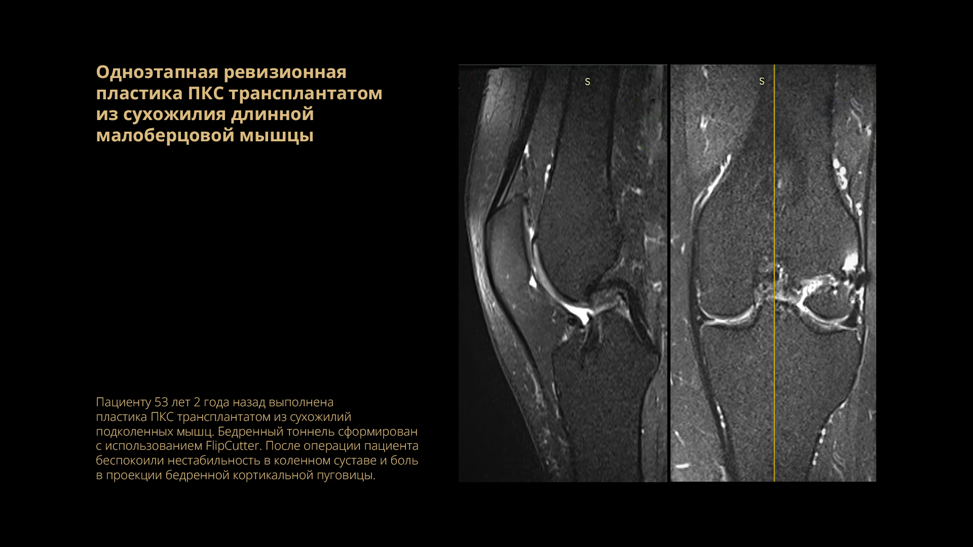 Одноэтапная ревизионная пластика ПКС трансплантатом из сухожилия длинной малоберцовой мышцы