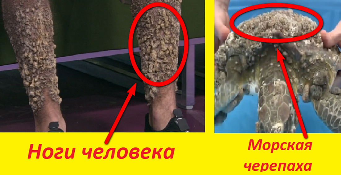 К ногам человека присосались черепашьеичи паразиты
