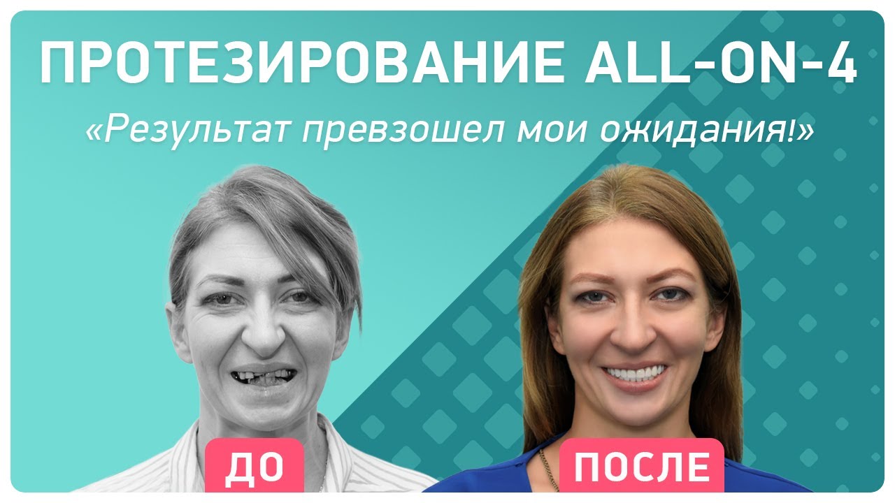 Через год после all-on-4 ? реальные ощущения пациента