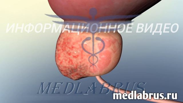 Аденома простаты против рака предстательной железы