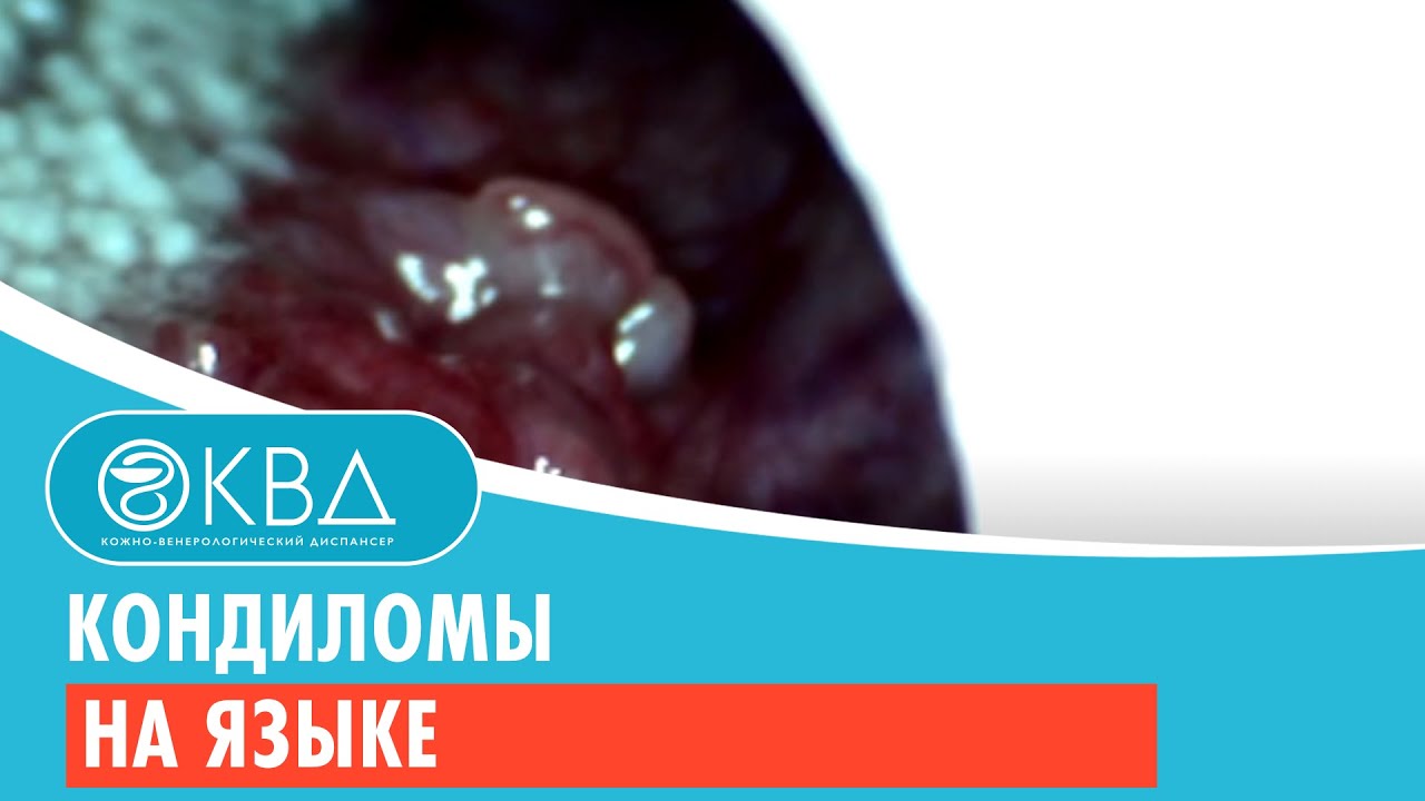 Кондиломы на языке. Клинический случай №6