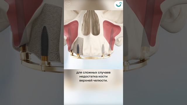 Как ставят скуловые импланты?