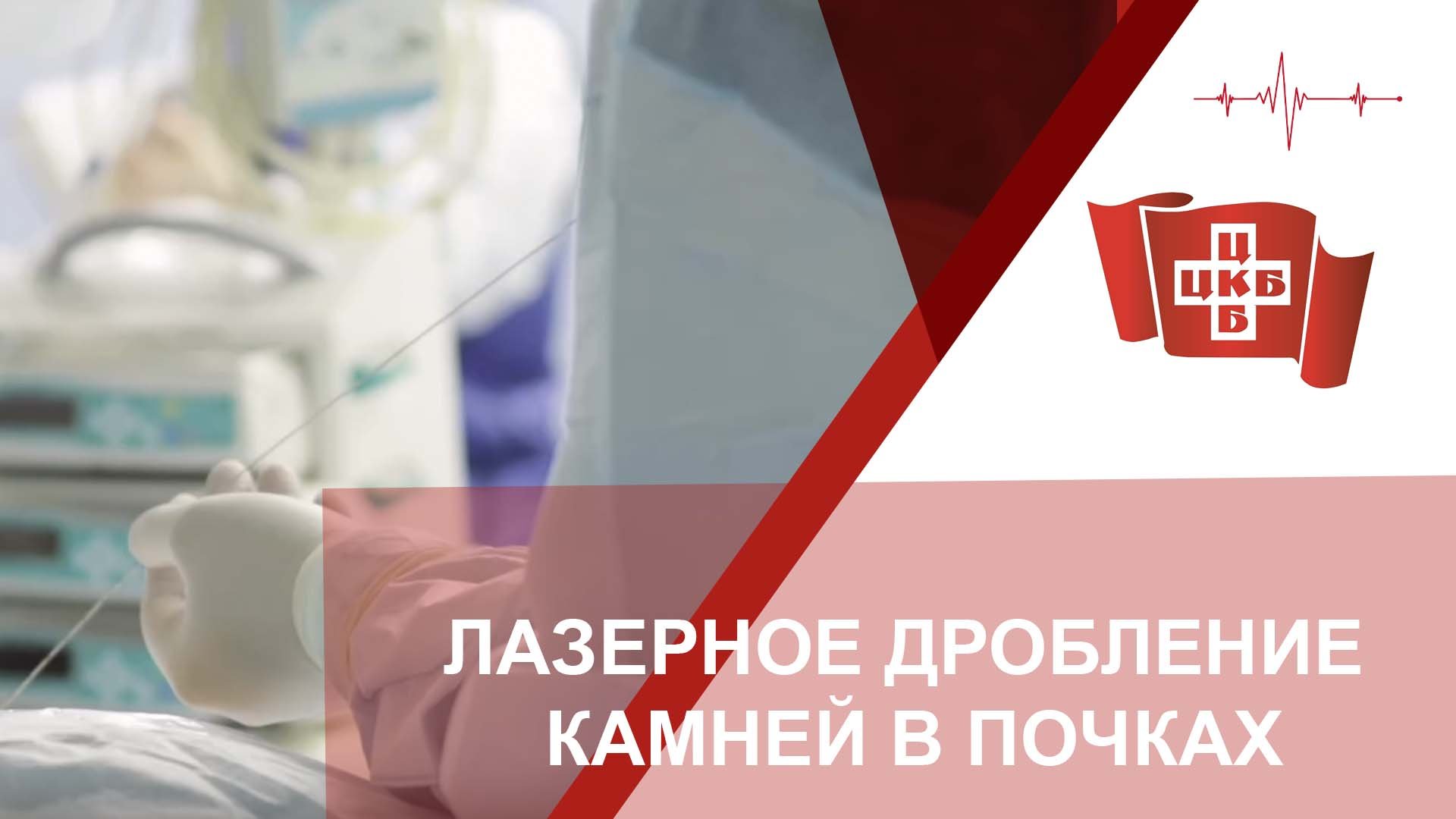 Лазерное дробление камней в почках