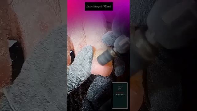 Онихогрифоз. Утолщение и деформация ногтей. см. в описании.