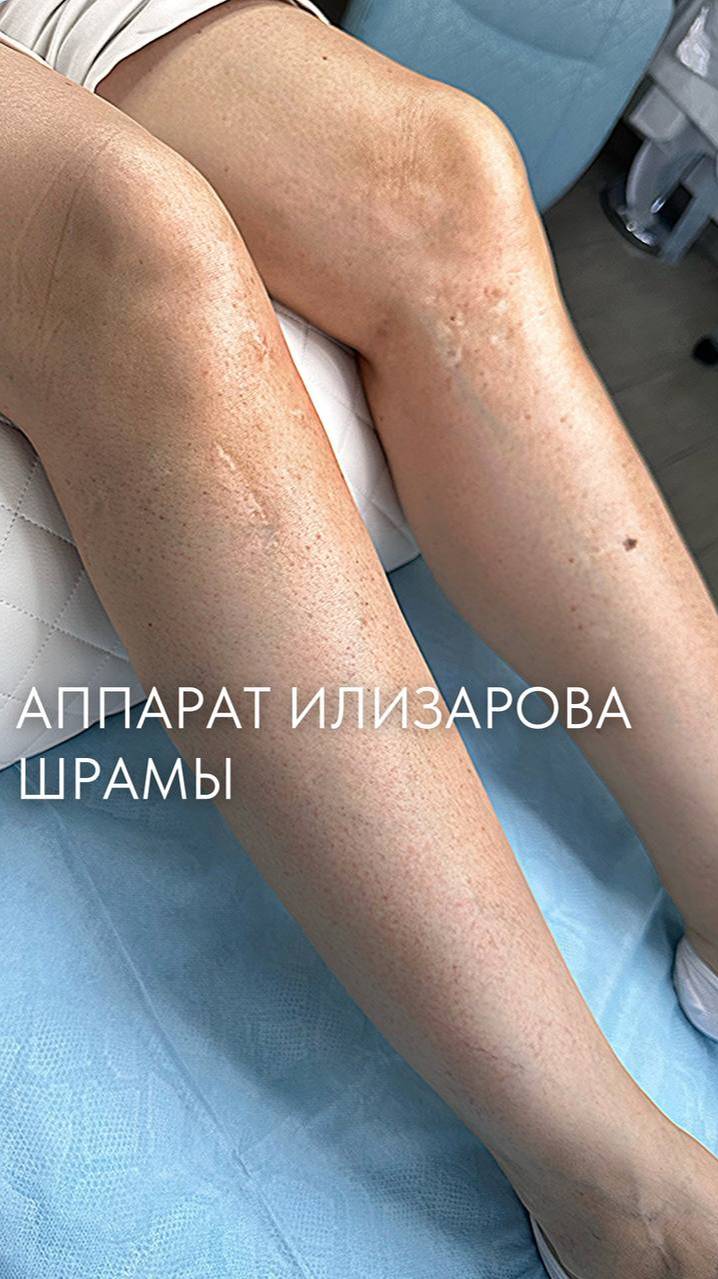 УБРАЛИ ШРАМЫ ПОСЛЕ АППАРАТА ЕЛИЗАРОВА |КАМУФЛЯЖ ШРАМОВ