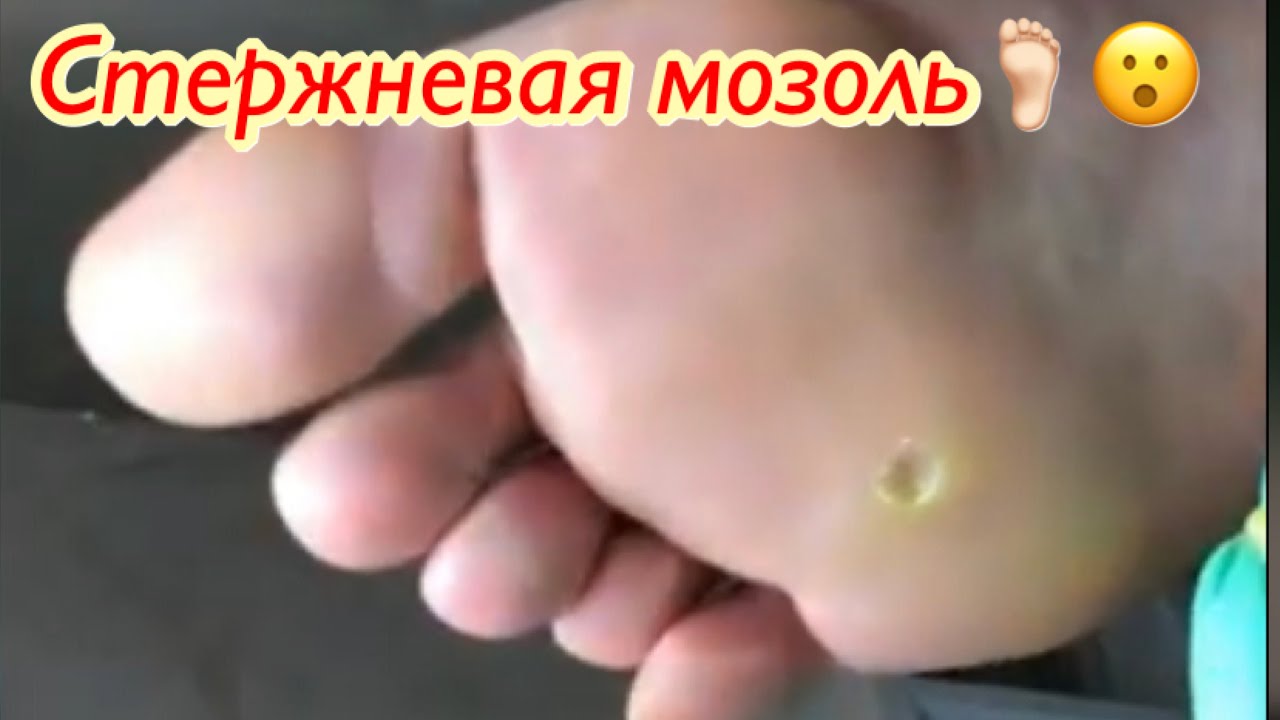 Стержневая мозоль??