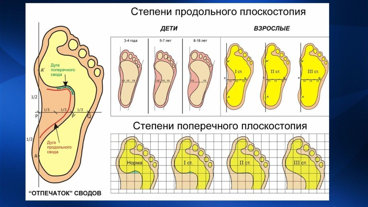 2.12. Массаж при плоскостопии, косолапости, деформациях | Медицинский массаж. Цикл 2