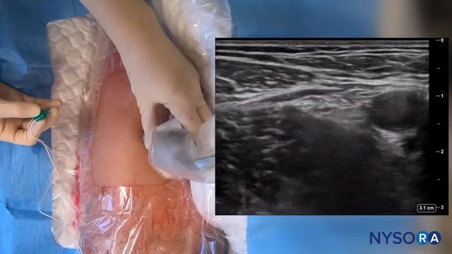 Блокада бедренного нерва (Ultrasound-Guided Femoral Nerve Block Crash course with Dr. Hadzic)