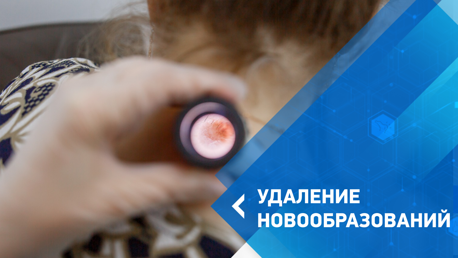 Удаление новообразований кожи