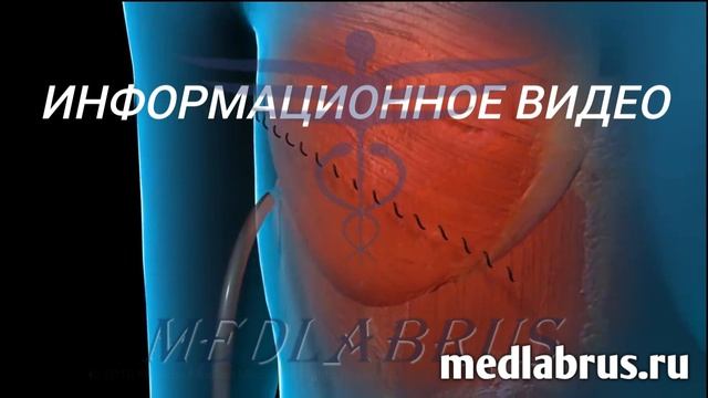 Рак груди-хирургическое удаление опухоли