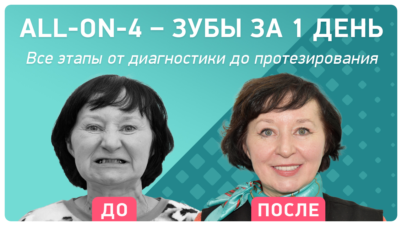Новые зубы за 1 день! Как проходит лечение ?  все этапы в одном видео