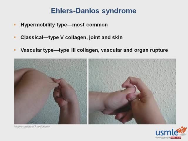 USMLE RX - 1.Биохимия - 1.Клеточная - 7.Синдром Элерса-Данлоса