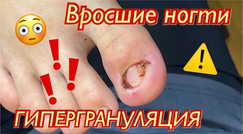 Вросшие ногти?⚠️❗️ • ГИПЕРГРАНУЛЯЦИЯ ???