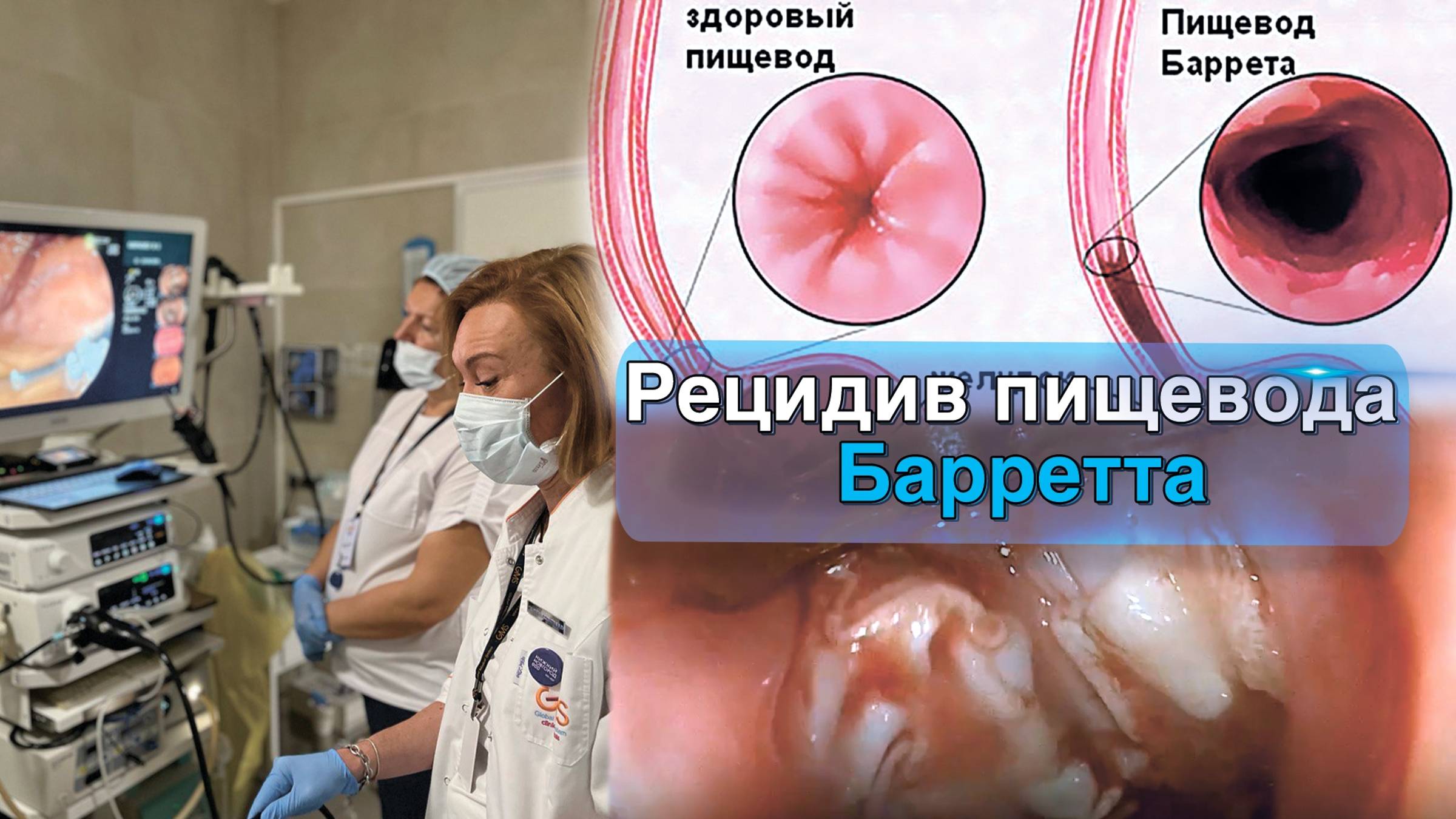 Пищевод Барретта + радиочастотная абляция BarrxTM Medtronic