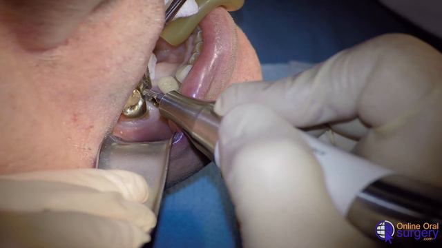 Удаление анкилозированного зуба