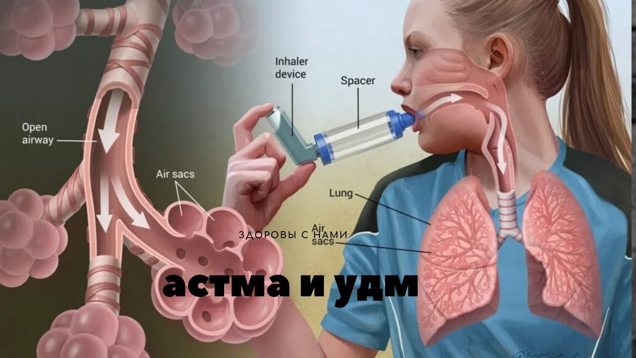 Астма много лет. Как отказаться от ингалятора.mp4
