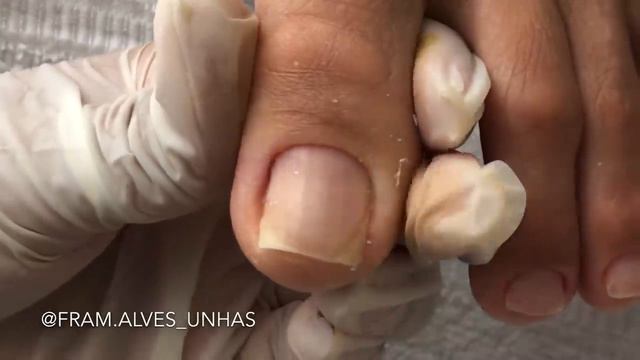 Fram Alves unhas 6 Removendo cutнcula do dedгo do pй