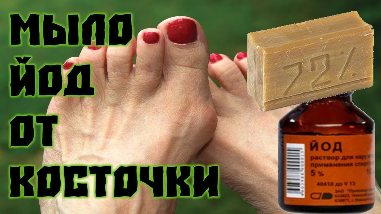 Хозяйственное мыло и йод от косточки на ноге!!!
