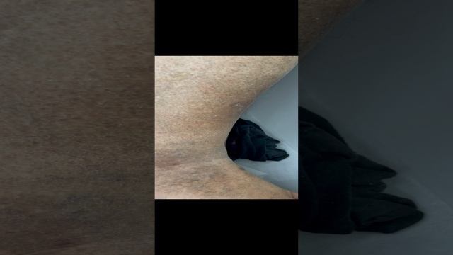 Повышенный вес. Ожирение. Отеки на ногах. Застой. Варикоз на ноге. Узи сосудов. Флеболог Москва