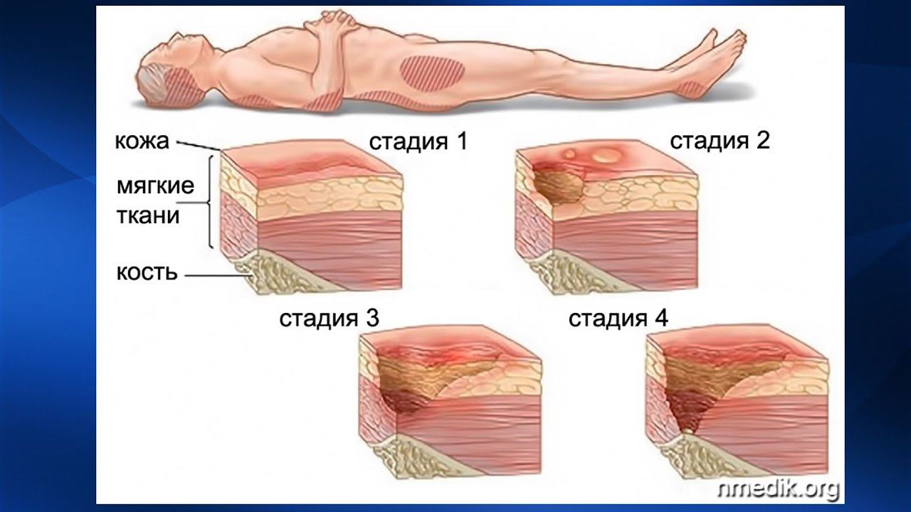2.04. Массаж для профилактики осложнений на постельном режиме | Ммедицинский массаж. Цикл 2