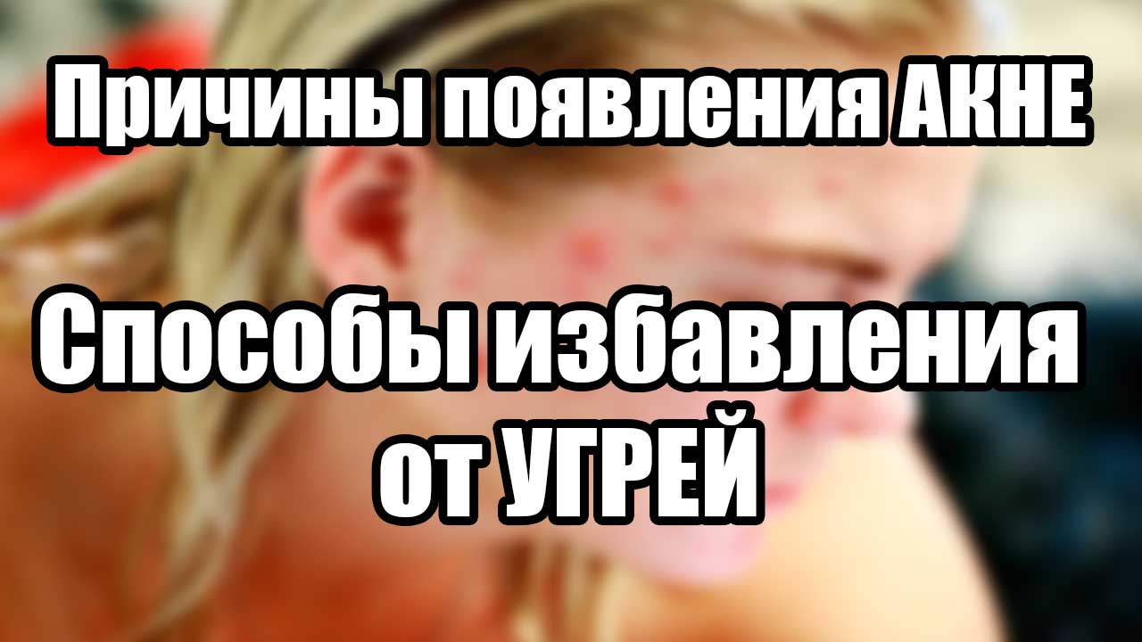 Причины появления АКНЕ. Способы избавиться от УГРЕЙ. Диета при акне. Прыщи на лице у подростков.