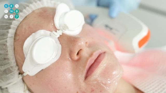 Лечение акне и угревой сыпи лазером | Сеть клиник косметологии GEN87