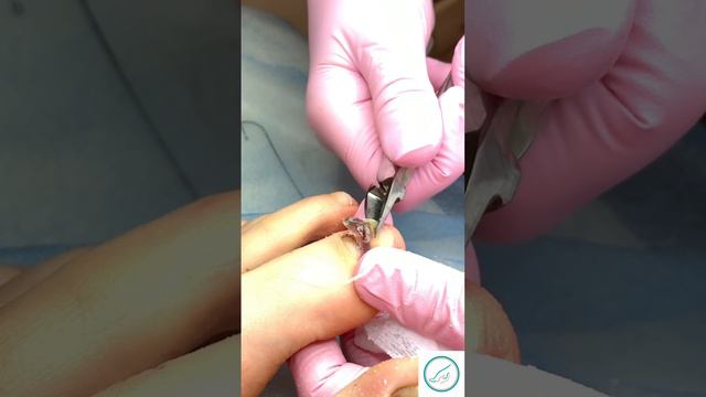 Гематома под ногтем, удаление, лечение. Подолог Симферополь.