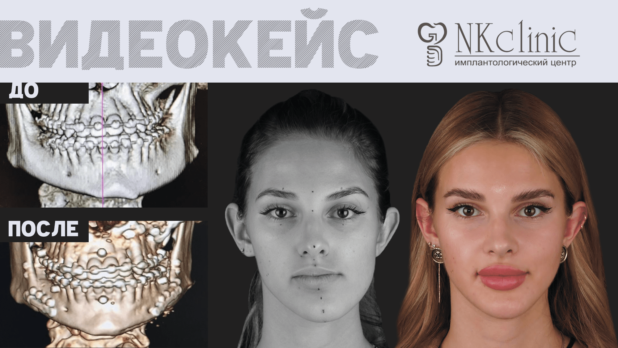 Исправление асимметрии лица и нарушения прикуса