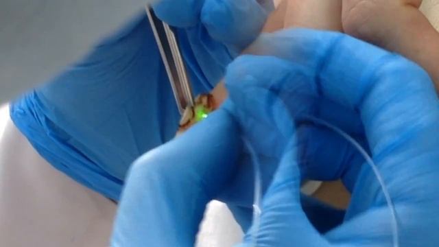 Удаление бородавки лазером в Уфе