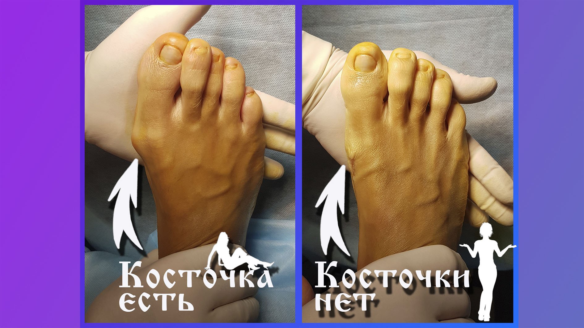 Шишка на стопе. TBL - метод. ДО и ПОСЛЕ.