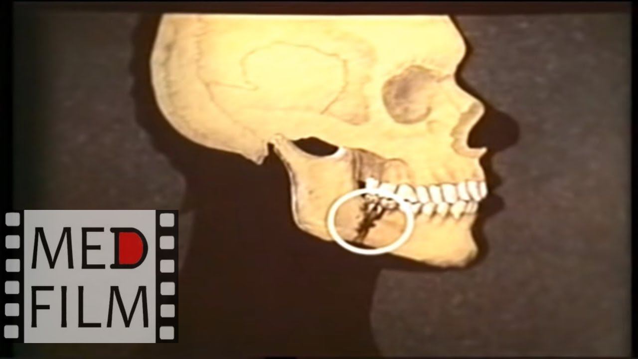 Аллопластика челюсти © Alloplasty mandible