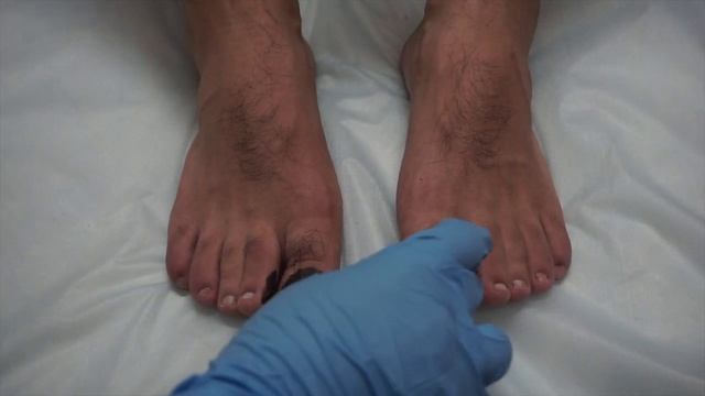 Лазерное Лечение Грибка Ногтей