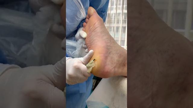 Гиперкератоз на стопе, обработка и удаление. Подолог Симферополь.